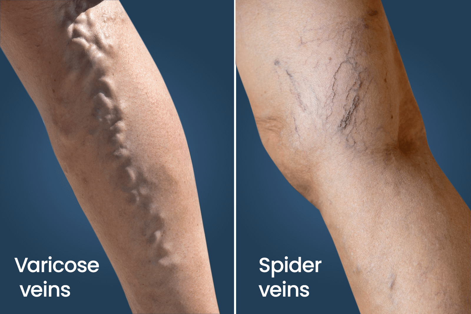 Vascular Surgery (Varicose Veins & DVT) – vidyanathhospital